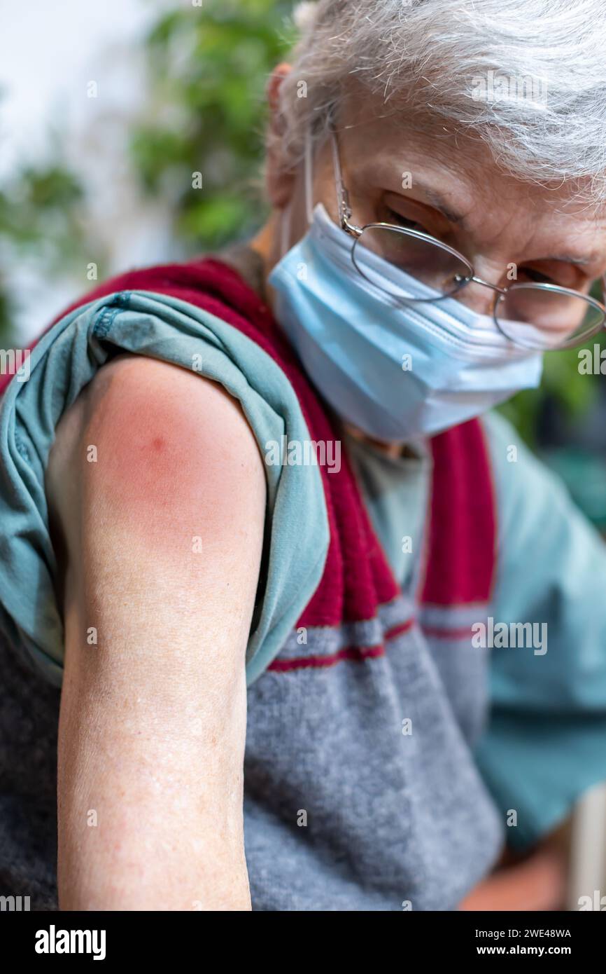 vaccine rash on elderly woman's arm Stock Photo - Alamy