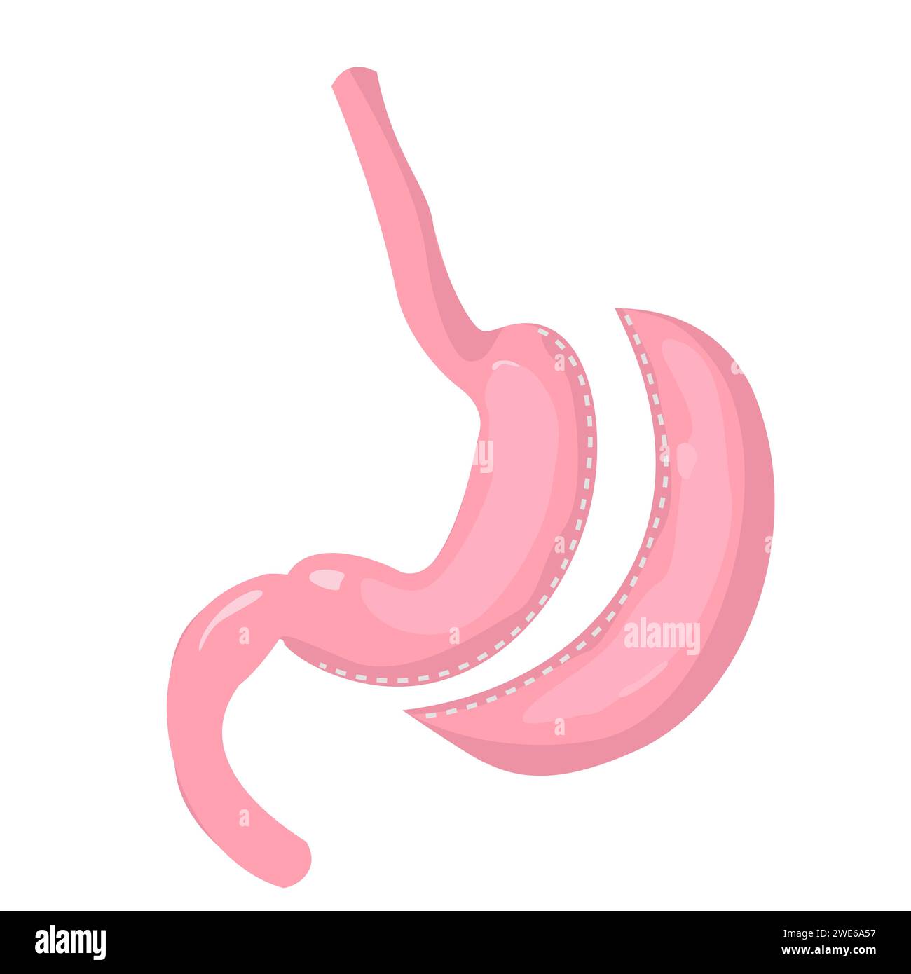 Gastric sleeve stomach. Methods of bariatric surgery. Human anatomy ...