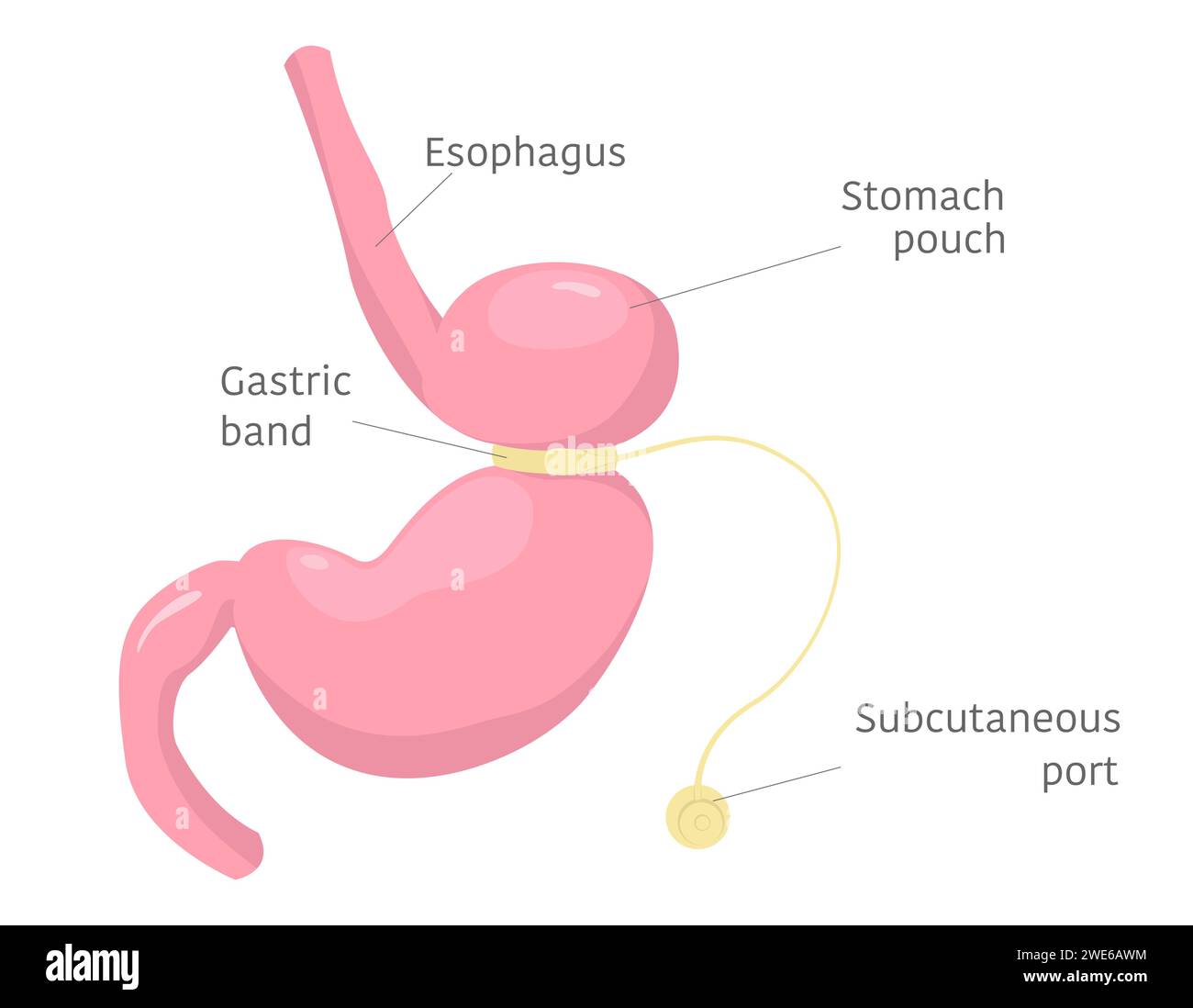 Adjustable gastric band on stomach. Human anatomy illustration for ...