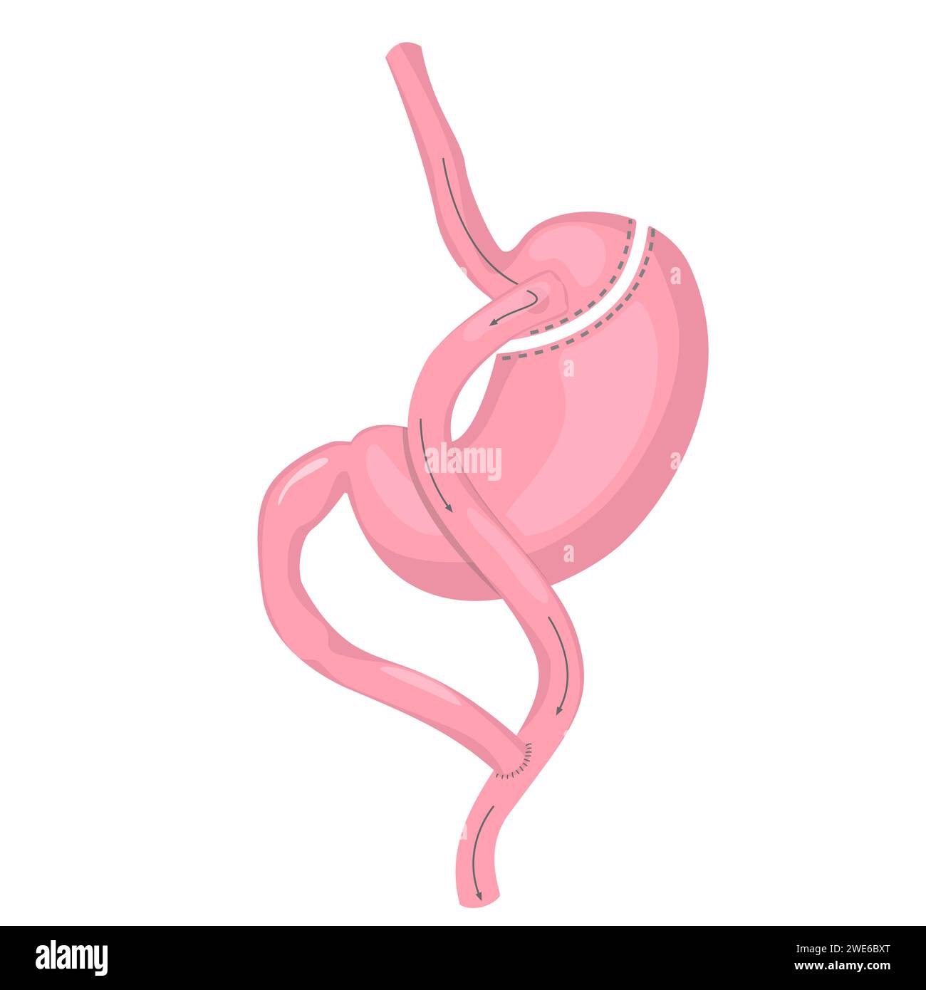 Bariatric surgery illustration Cut Out Stock Images & Pictures - Alamy