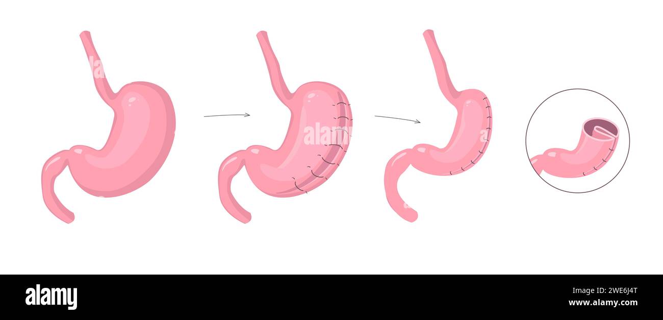 Gastric plication infographics. The explanation picture of stomach ...