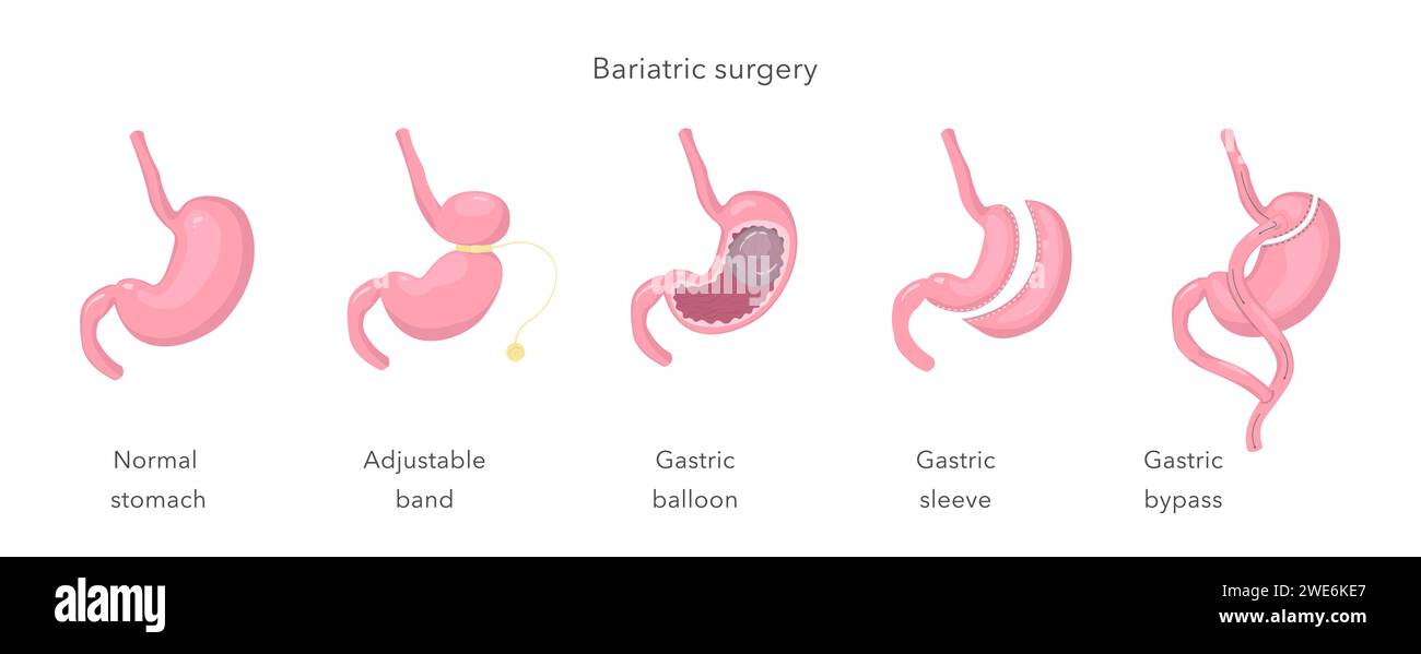 Methods of weight loss operation. Bariatric surgery. Human anatomy illustration for infographics ...