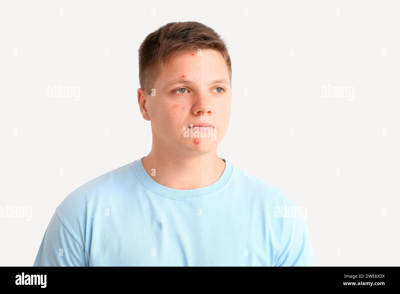 Comparison portrait of teenage boy before and after acne treatment on ...