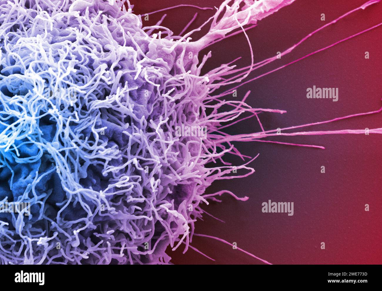 Cervical cancer cell, SEM Stock Photo - Alamy