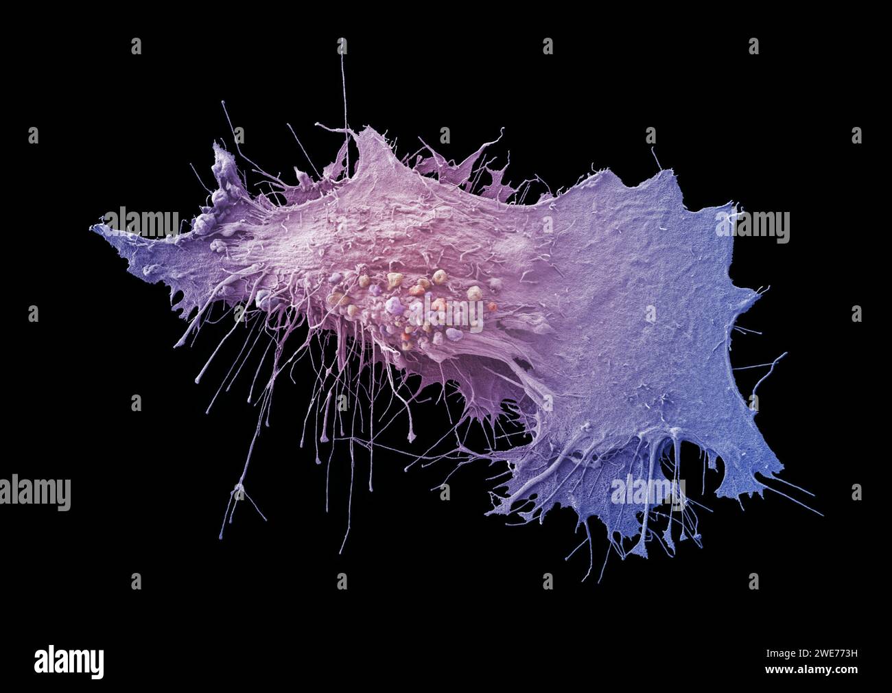 Cervical cancer cell, SEM Stock Photo - Alamy