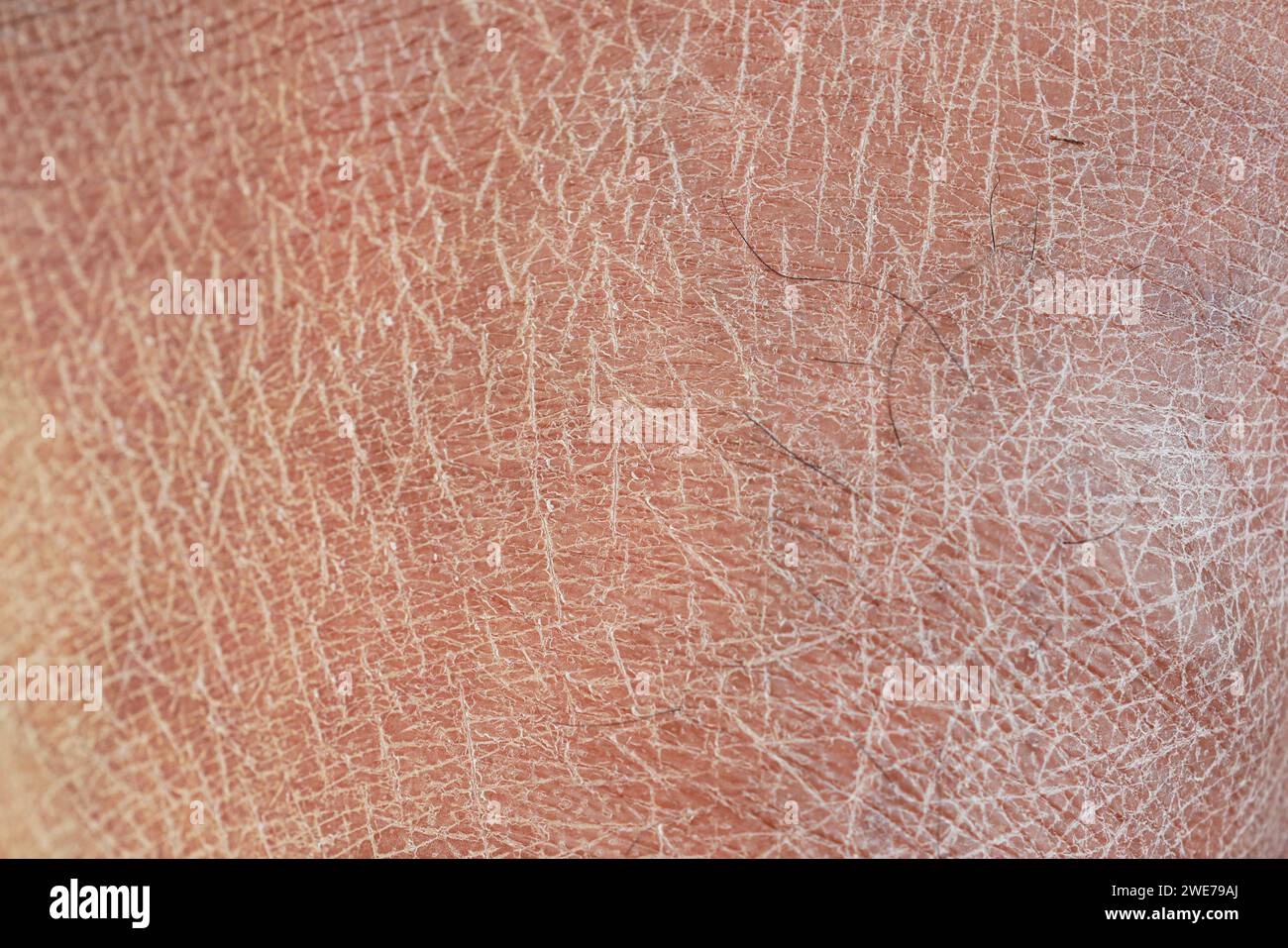 Closeup view of dry human skin Stock Photo - Alamy