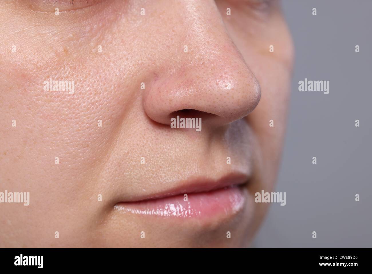 Comedones hi-res stock photography and images - Alamy