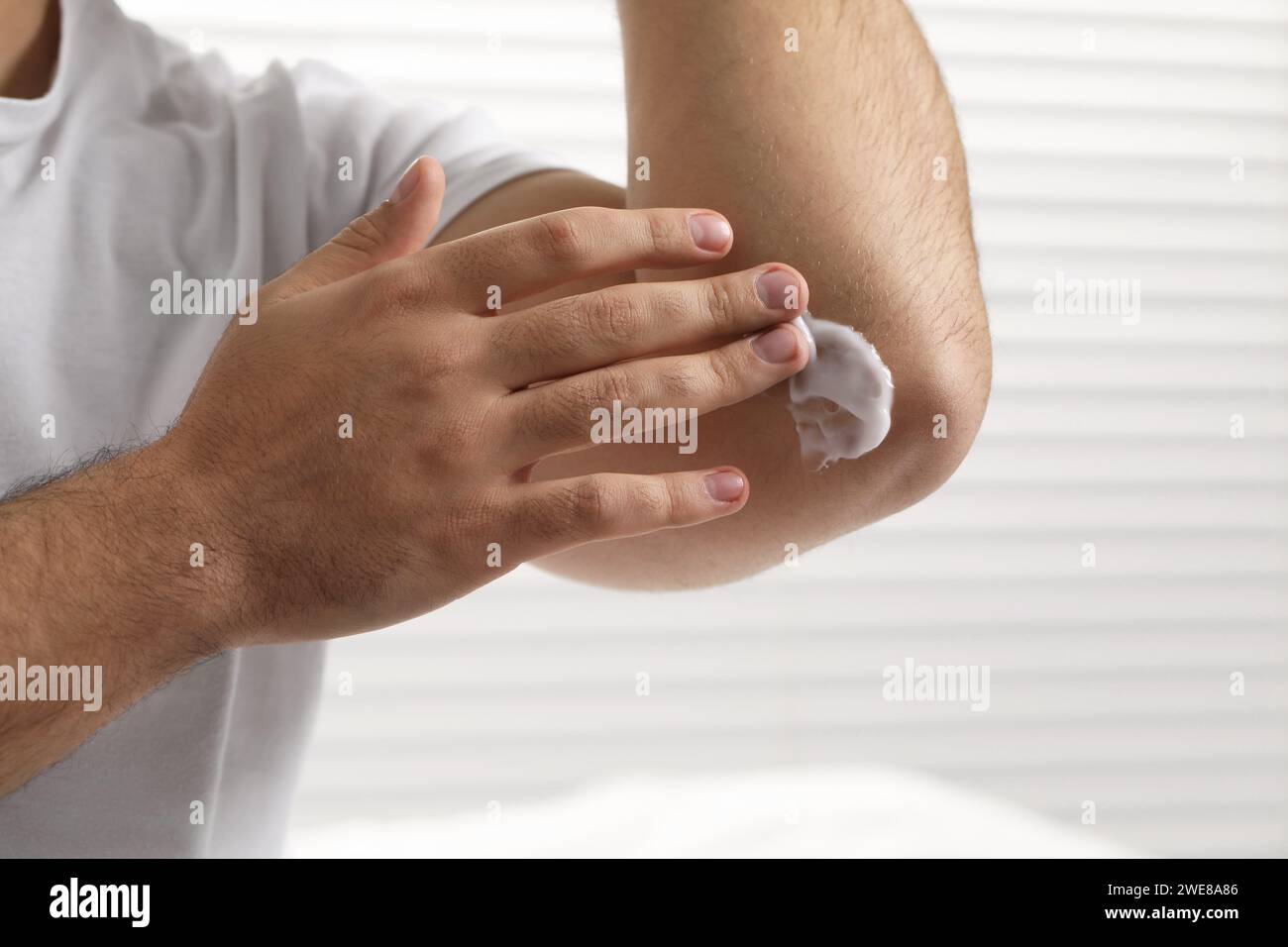 Man with dry skin applying cream onto his elbow on light background ...