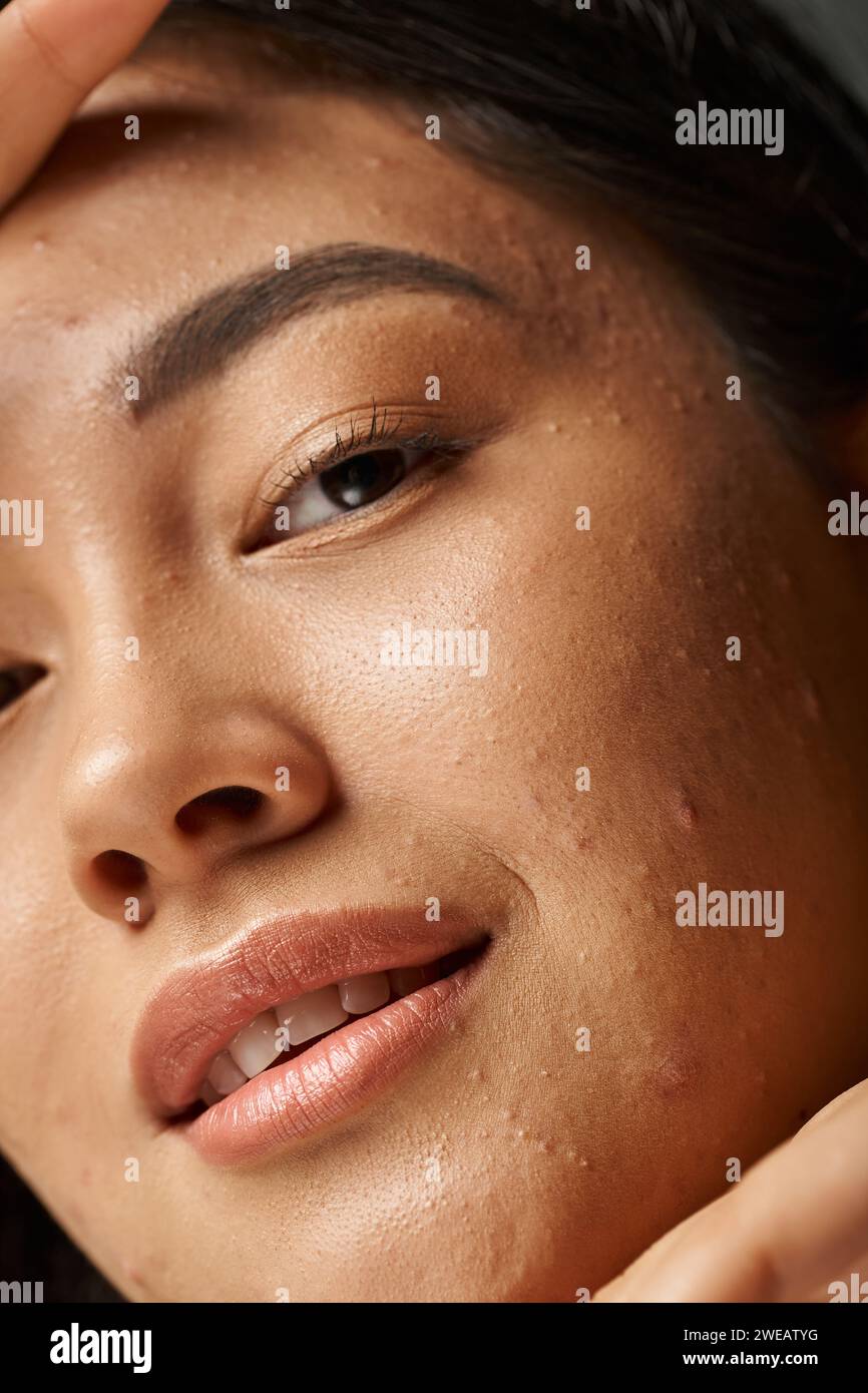 close up photo of young asian woman with acne prone skin looking at ...