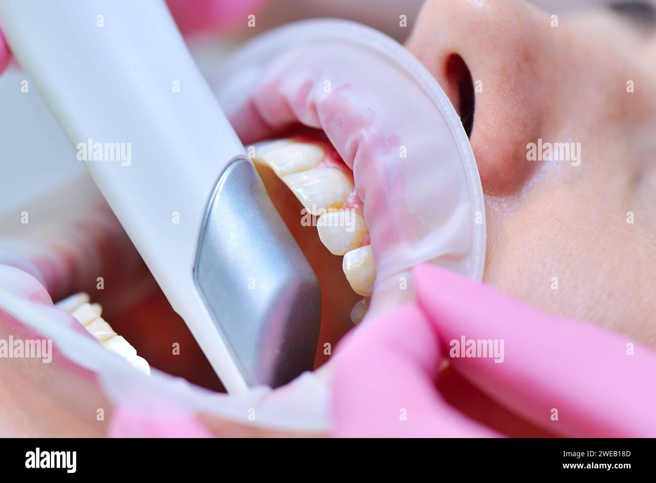 Close up of dentist doing dental 3d scanning of patients teeth ...