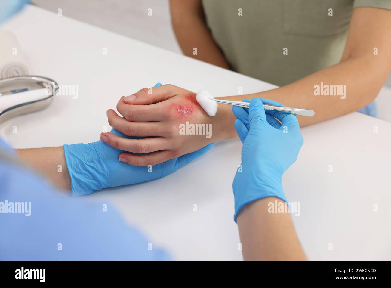 Doctor treating patient's burned hand at table, closeup Stock Photo - Alamy