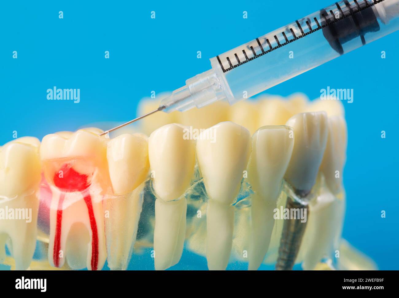 Injection Of An Anesthetic Drug Into The Gum Of A Diseased Tooth For