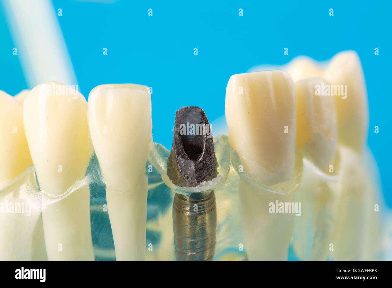 Dental pin hi-res stock photography and images - Alamy