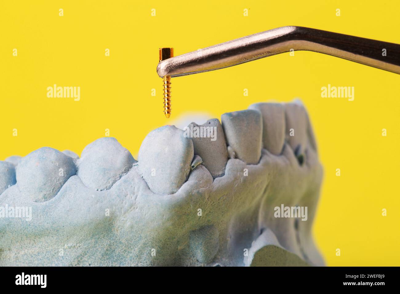 Fiberglass cast hi-res stock photography and images - Alamy