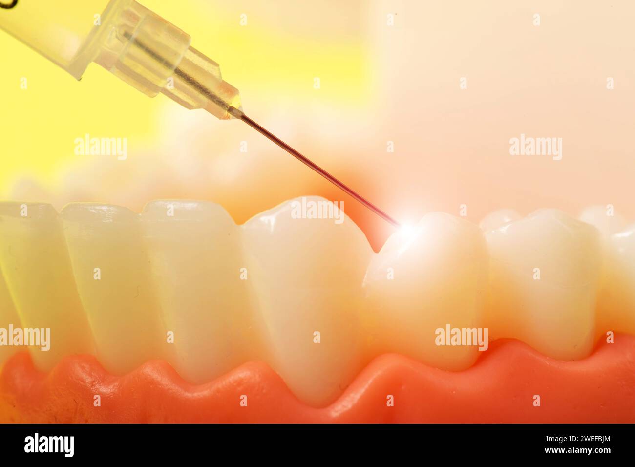 Injection Of An Anesthetic Drug Into The Gum Of A Diseased Tooth For