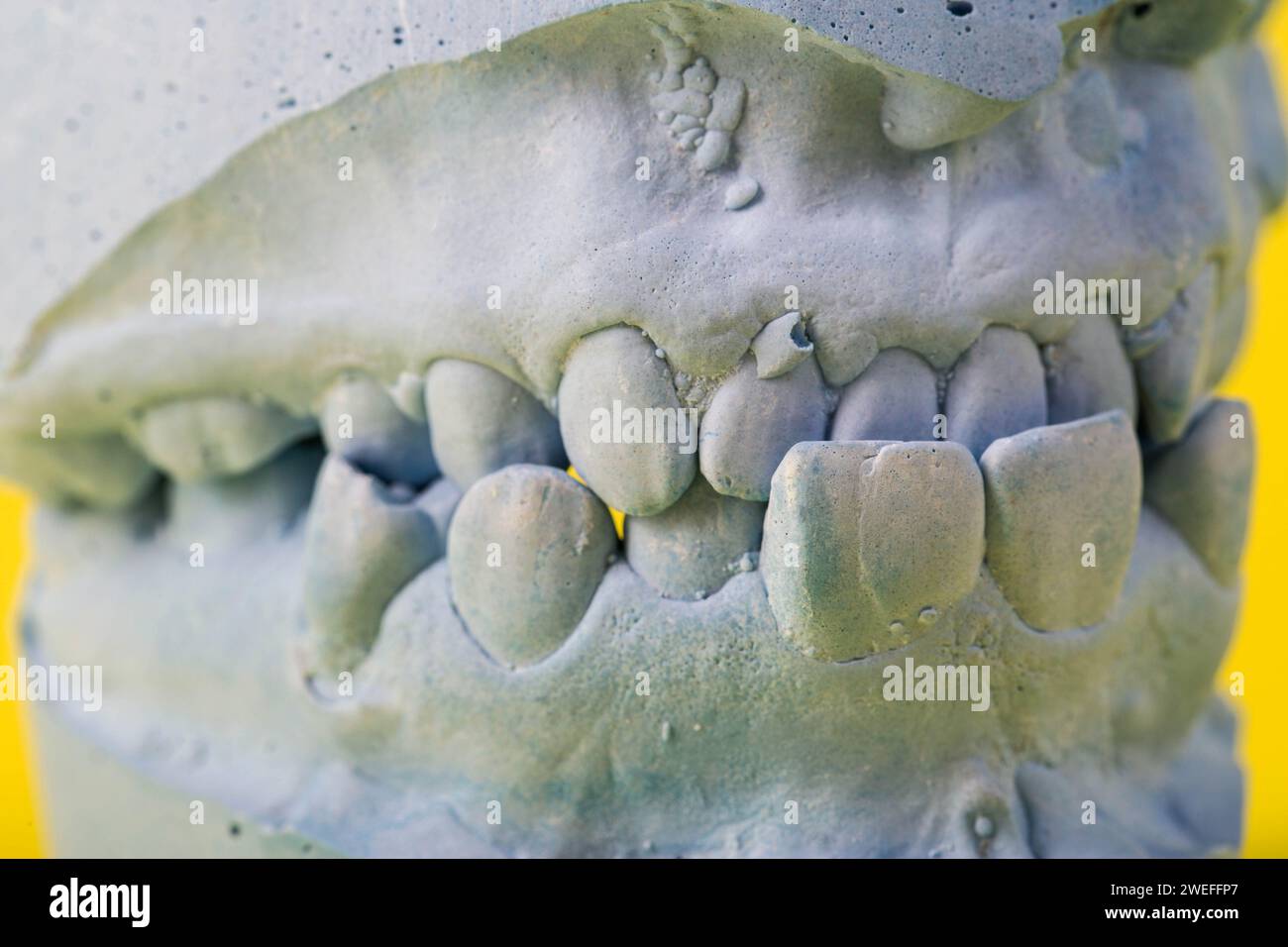 Blue plaster impression of the dental jaw of a patient with crooked ...