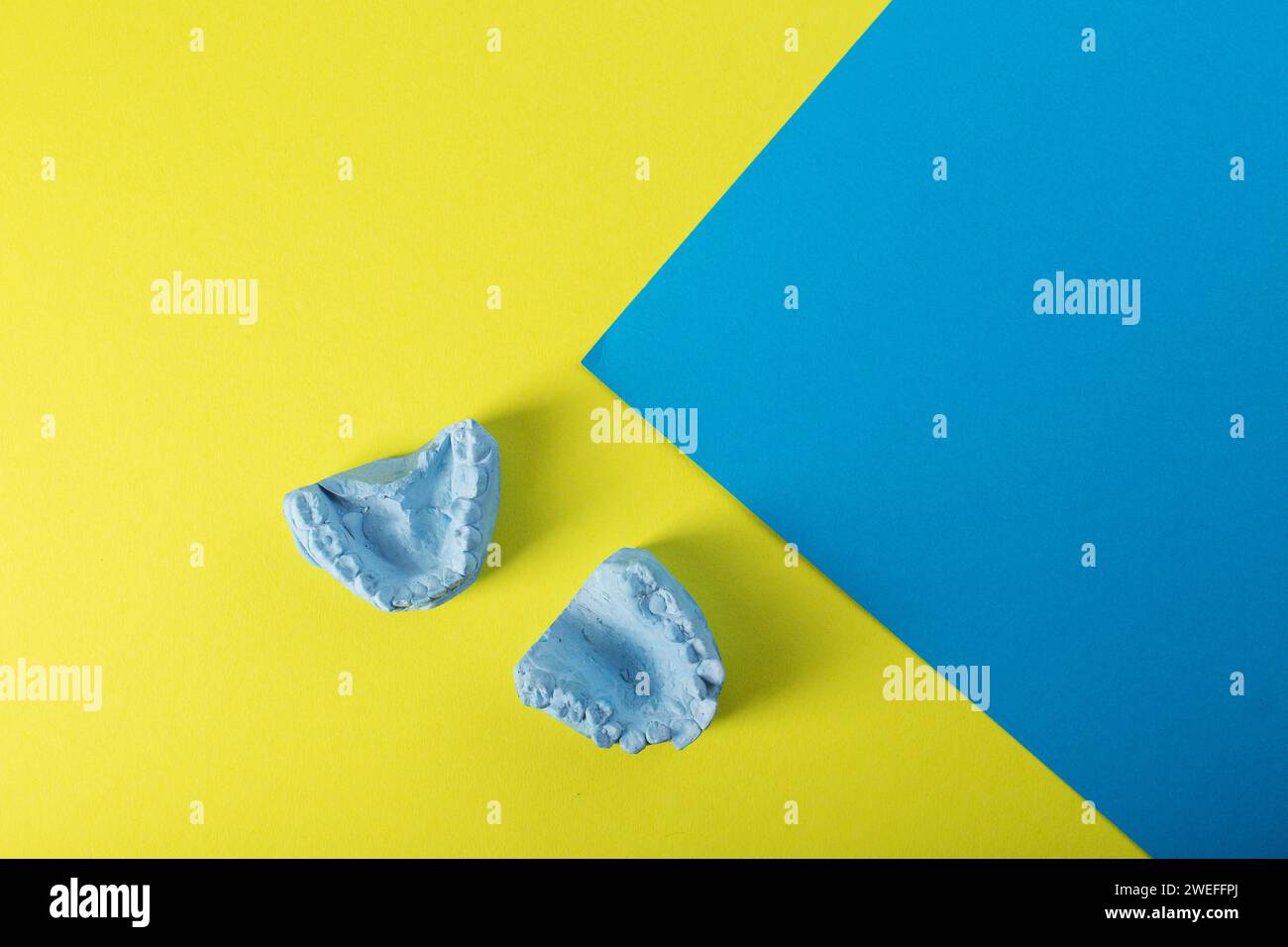 Blue plaster impression of a patient's dental jaw with crooked teeth ...