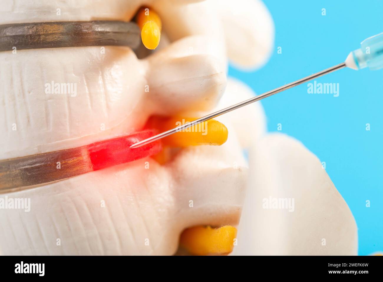 An injection from a syringe with an anesthetic drug into an ...