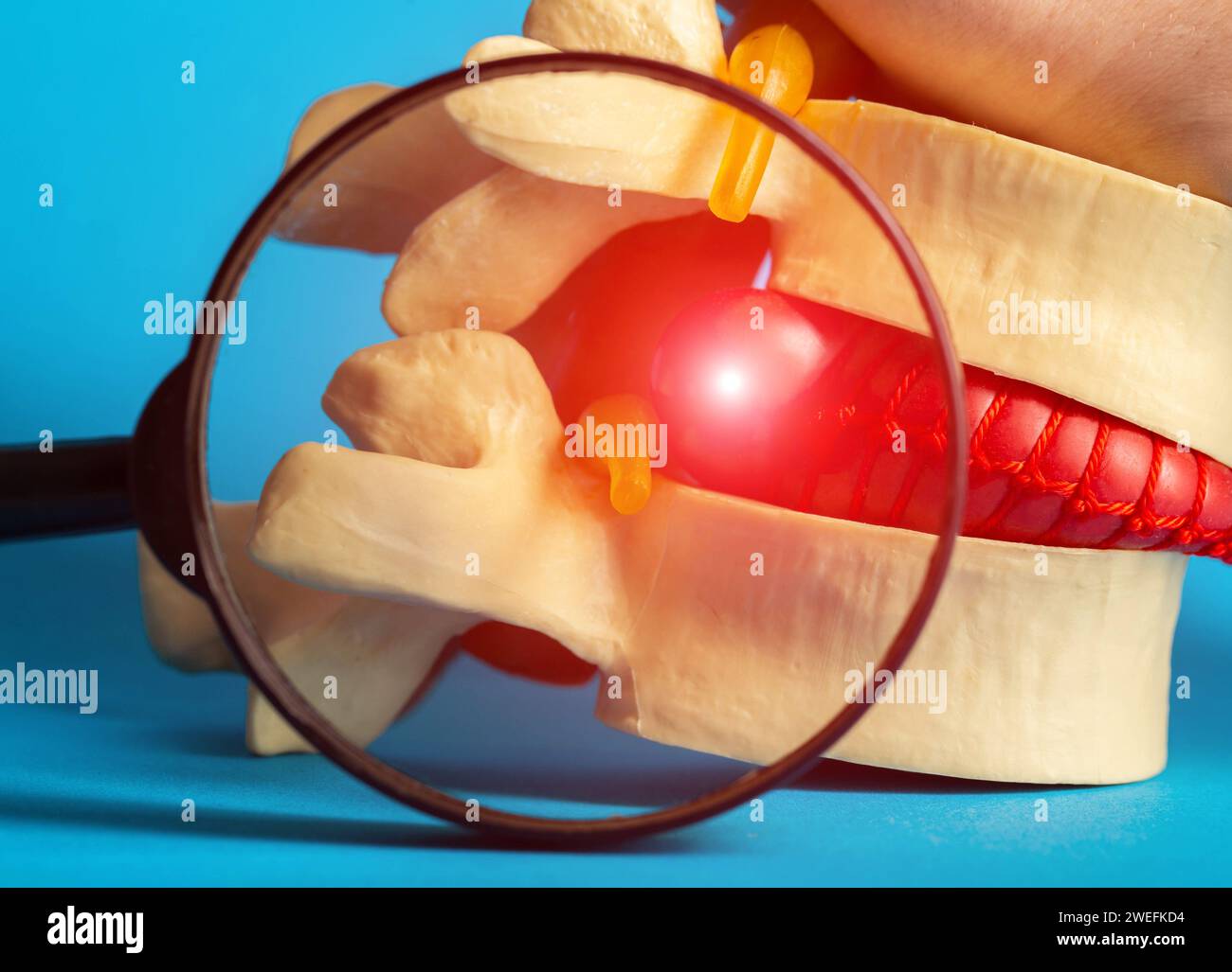 Inflamed red herniated disc of the spine under a magnifying glass ...