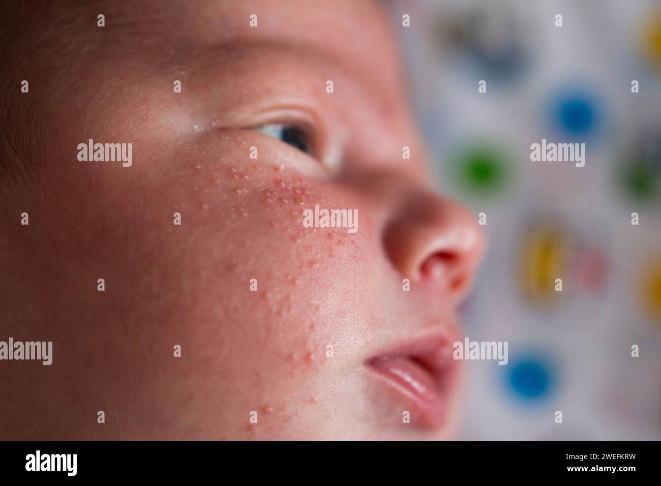 Rash on the cheeks hi-res stock photography and images - Alamy