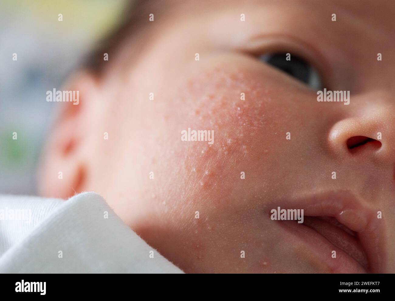 Rash on the face of a newborn baby. The process of formation of the ...