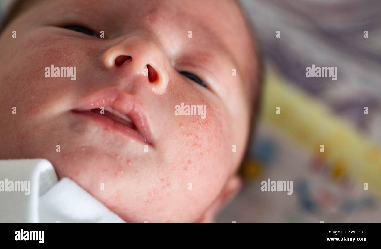 Allergic pimples in a newborn on the face. Pathogenesis, acne of ...