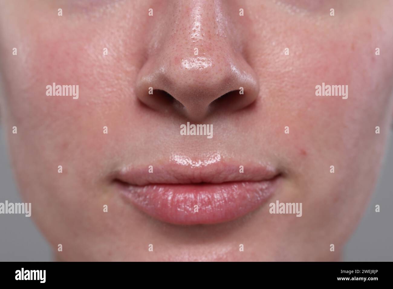 Closeup view of woman with reddened skin on grey background Stock Photo ...
