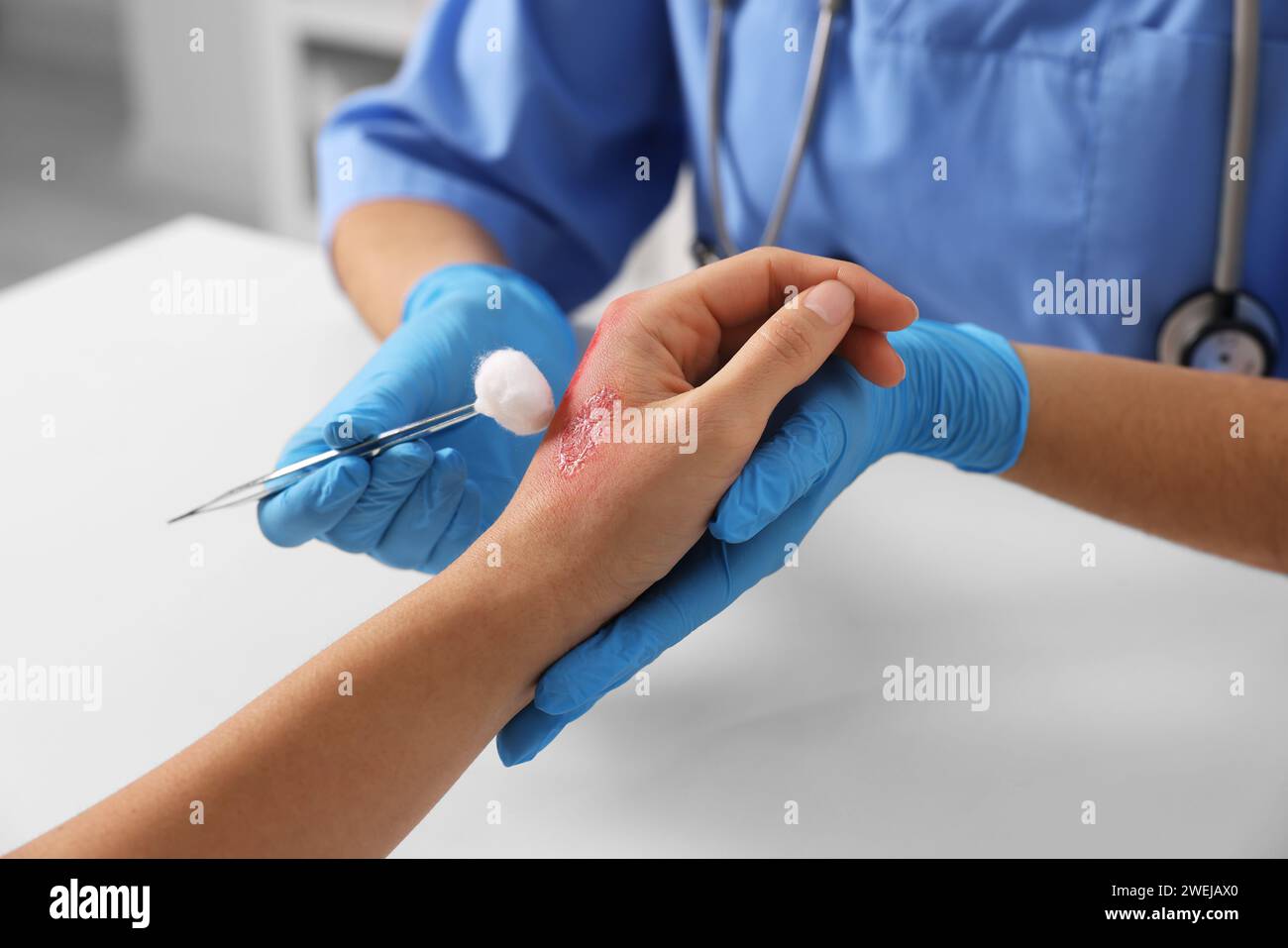 Doctor treating patient's burned hand at table, closeup Stock Photo - Alamy