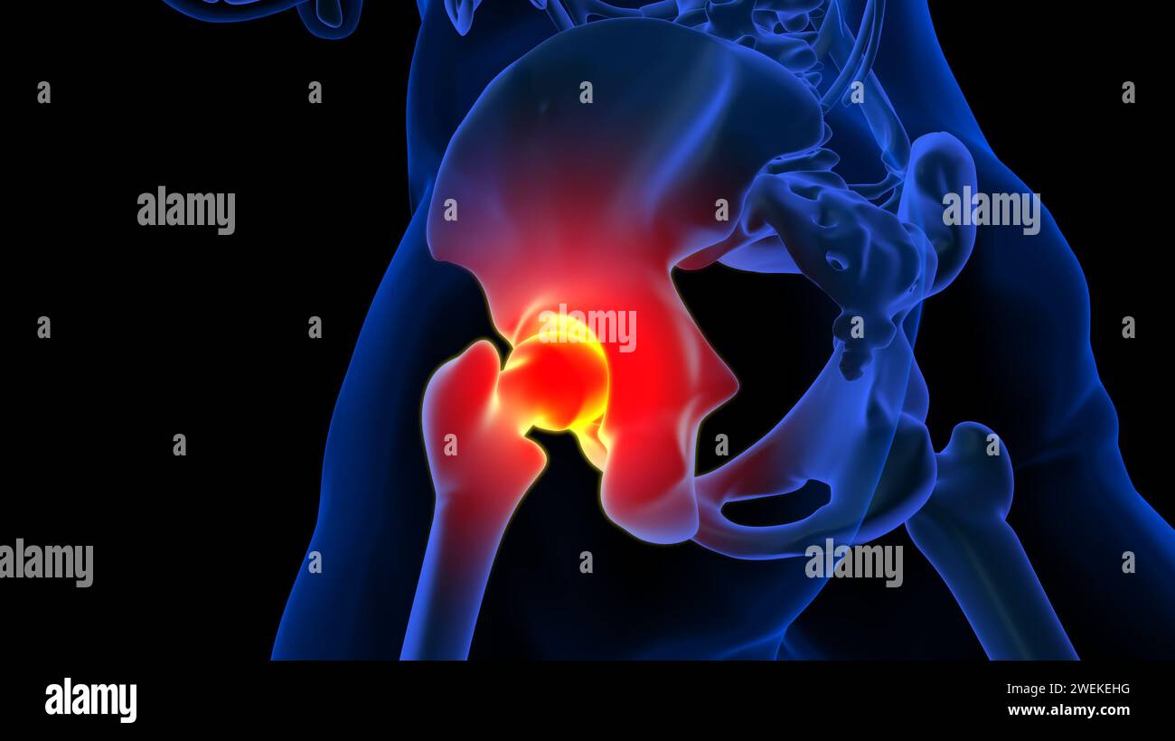 Hip joint pain anatomy for medical concept 3D illustration Stock Photo ...