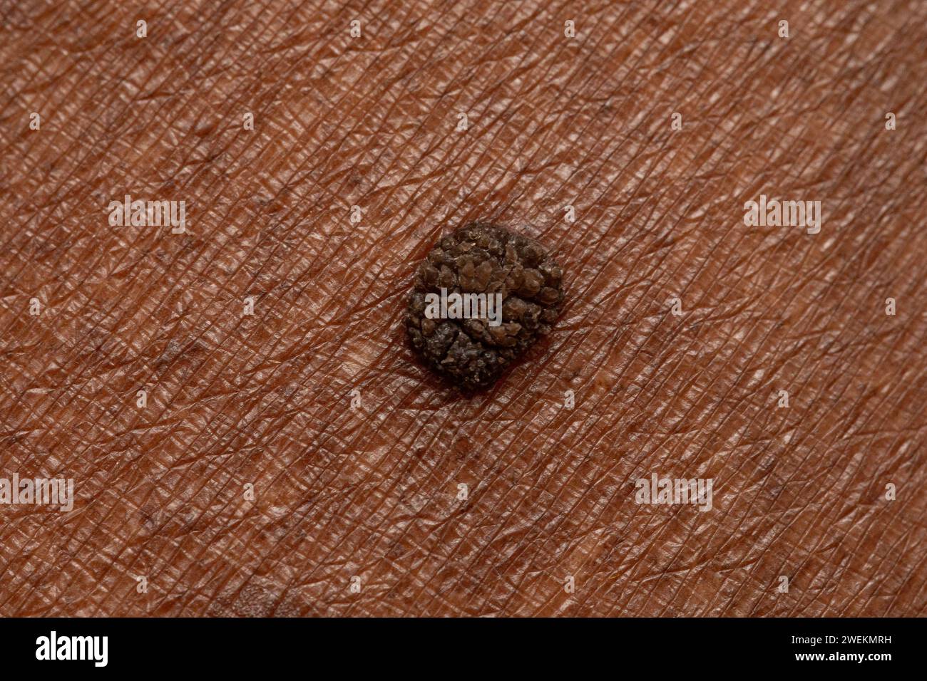 Macro Of A Brown Seborrheic Keratosis A Common Noncancerous Benign Skin Growth On African
