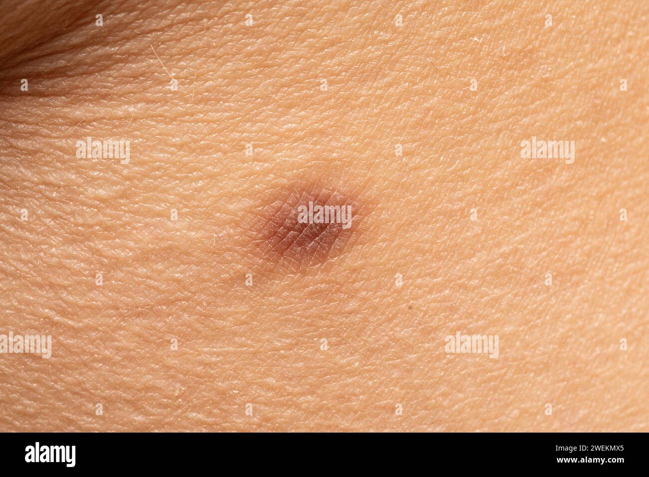 Macro of a brown seborrheic keratosis, a common noncancerous (benign ...