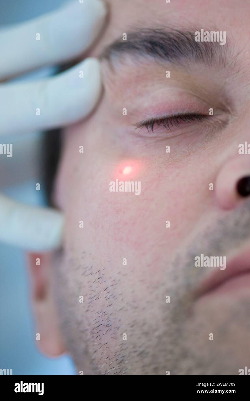 Man Receiving Laser Treatment on Face Stock Photo - Alamy