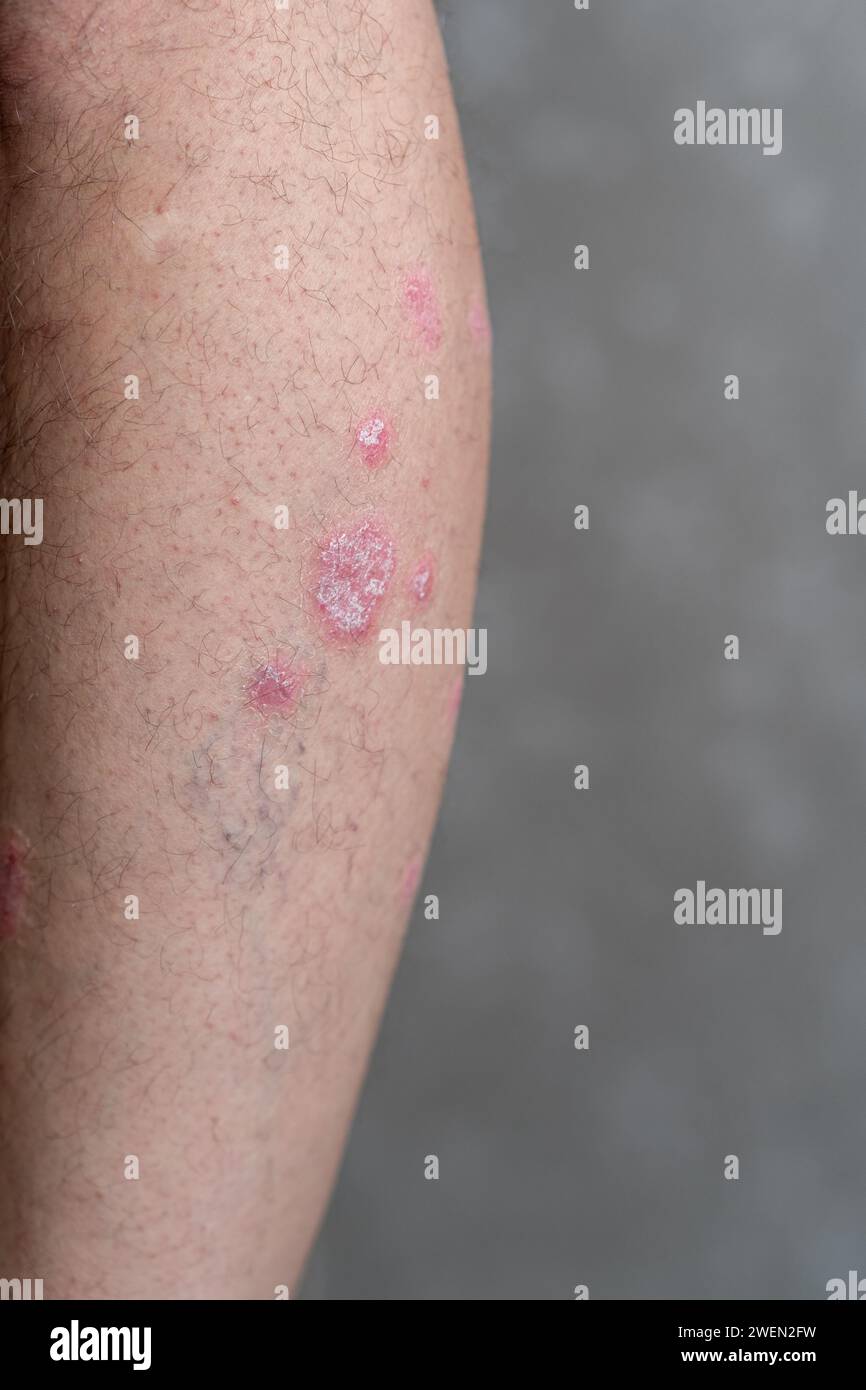 Psoriasis Vulgaris, skin patches are typically red, itchy, and scaly ...