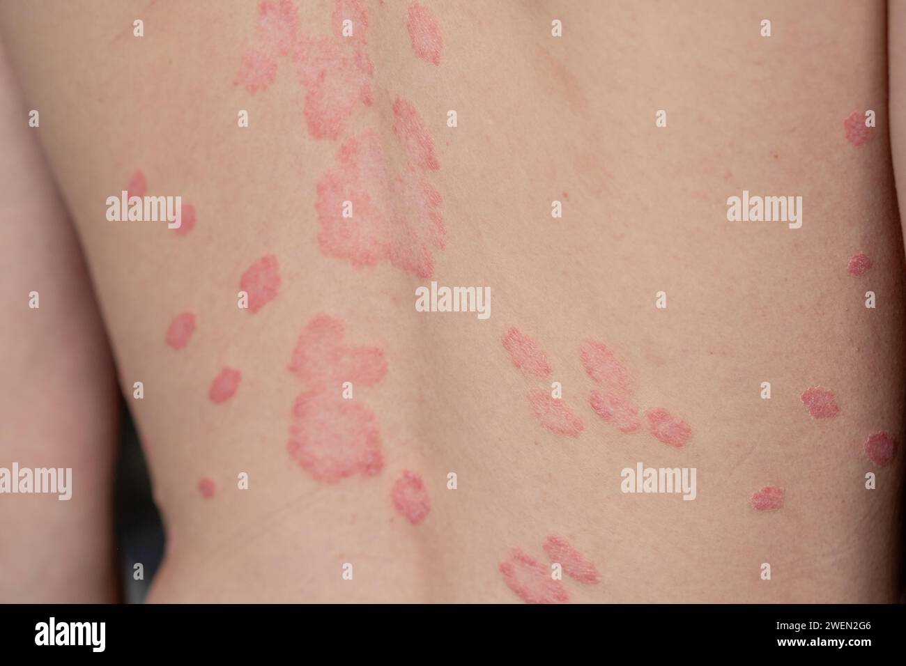 Psoriasis Vulgaris, skin patches are typically red, itchy, and scaly ...