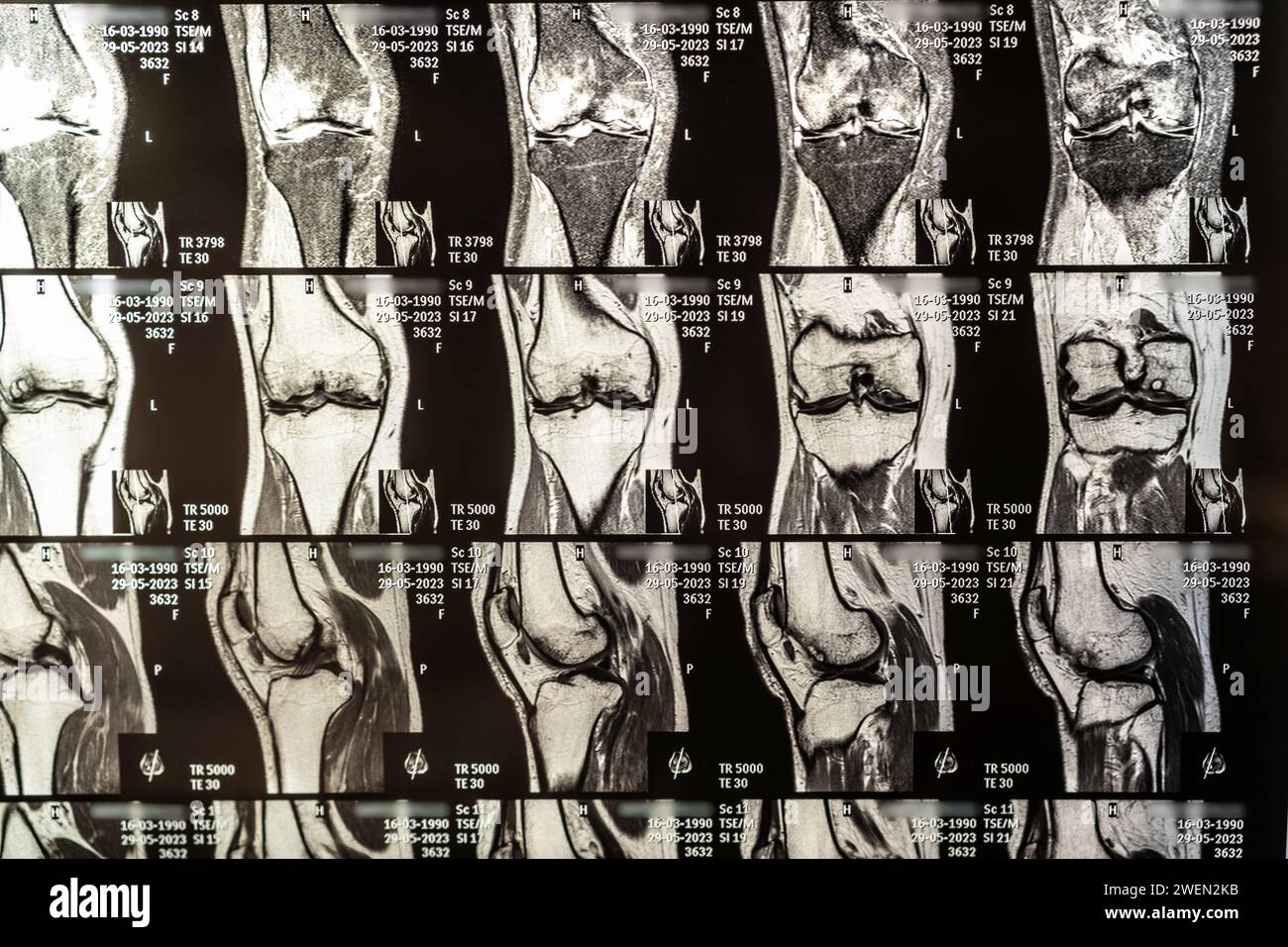 Magnetic resonance imaging of human knee joint for medical diagnosis Stock Photo - Alamy