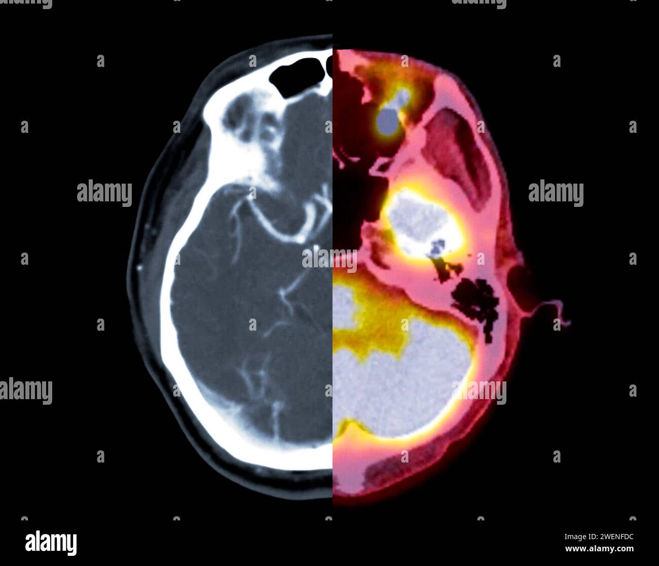 CT scan of the brain Axial view for diagnosis brain tumor,stroke ...