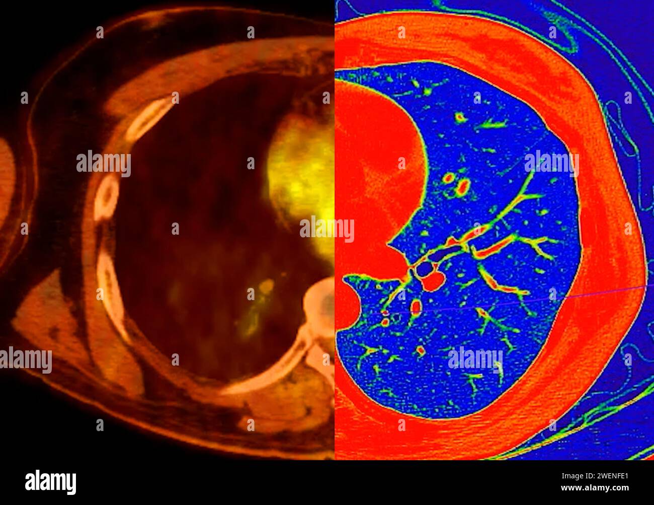 Ct Scan Of Chest Axial View In Color Mode For Diagnostic Pulmonary