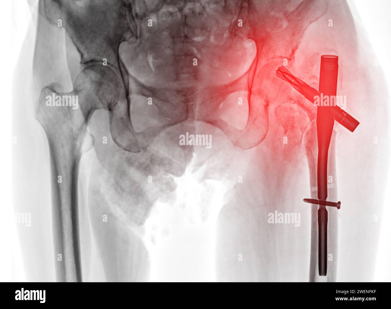 An X-ray reveals both hip joints with hemiarthroplasty, showcasing the ...