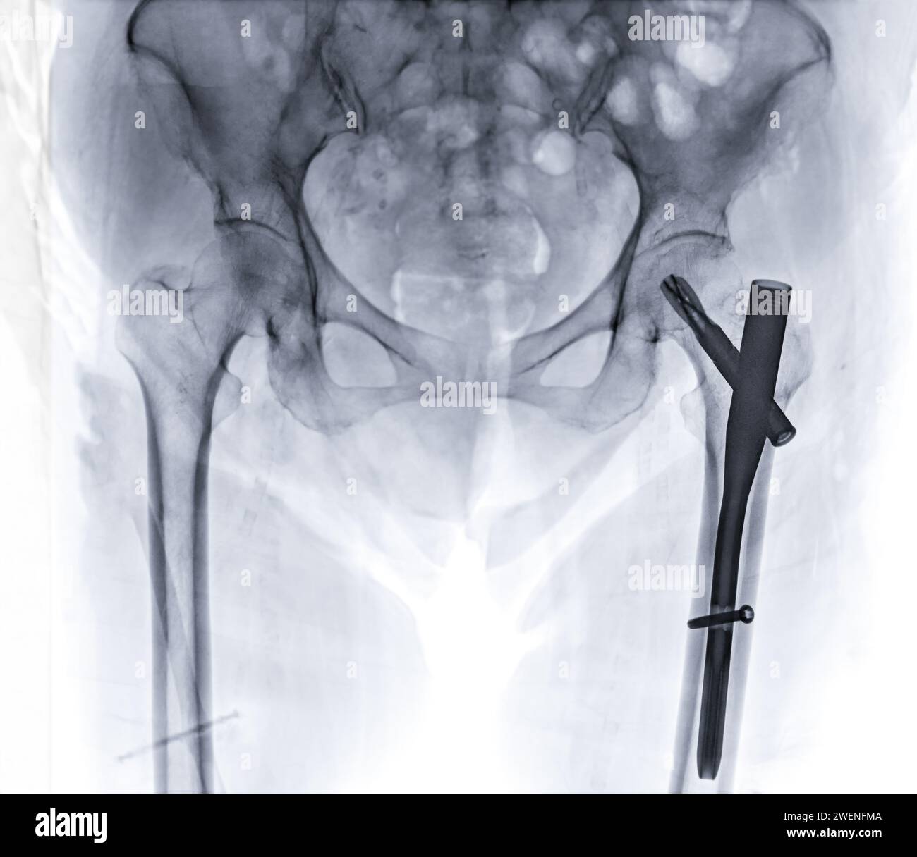 An X-ray reveals both hip joints with hemiarthroplasty, showcasing the ...