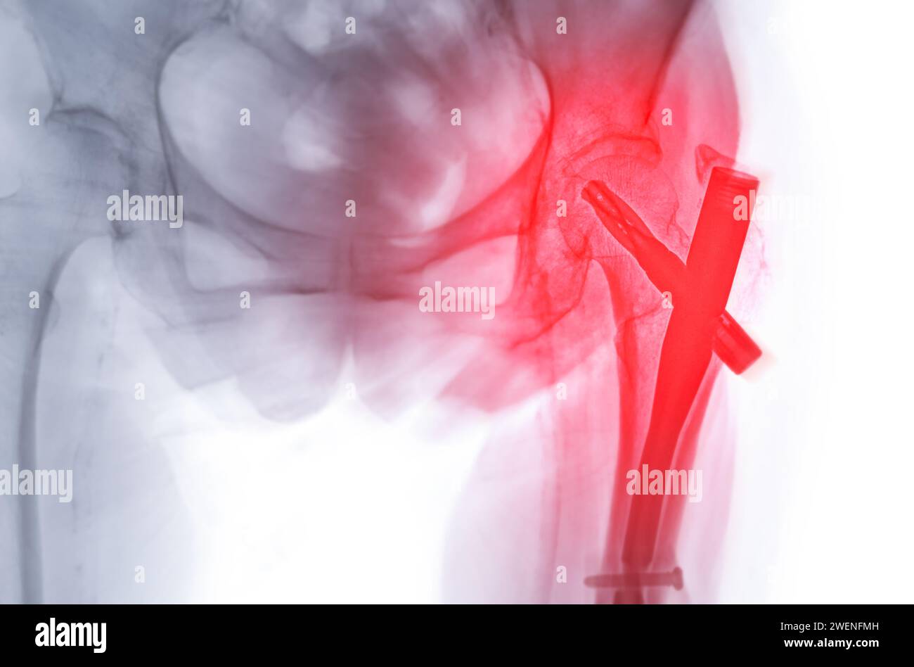 An X-ray reveals both hip joints with hemiarthroplasty, showcasing the ...