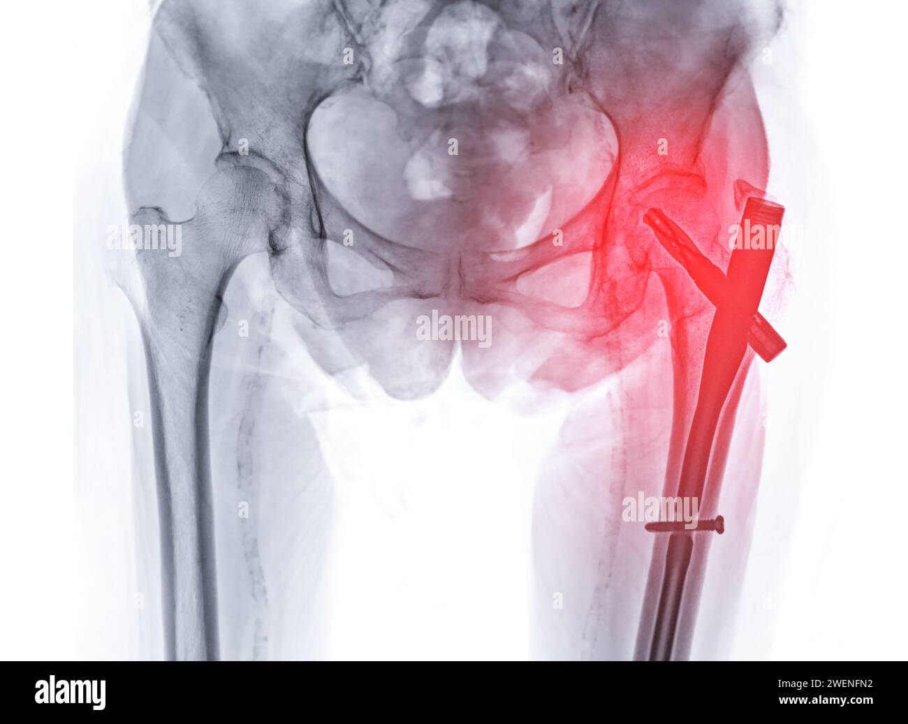 An X-ray reveals both hip joints with hemiarthroplasty, showcasing the ...