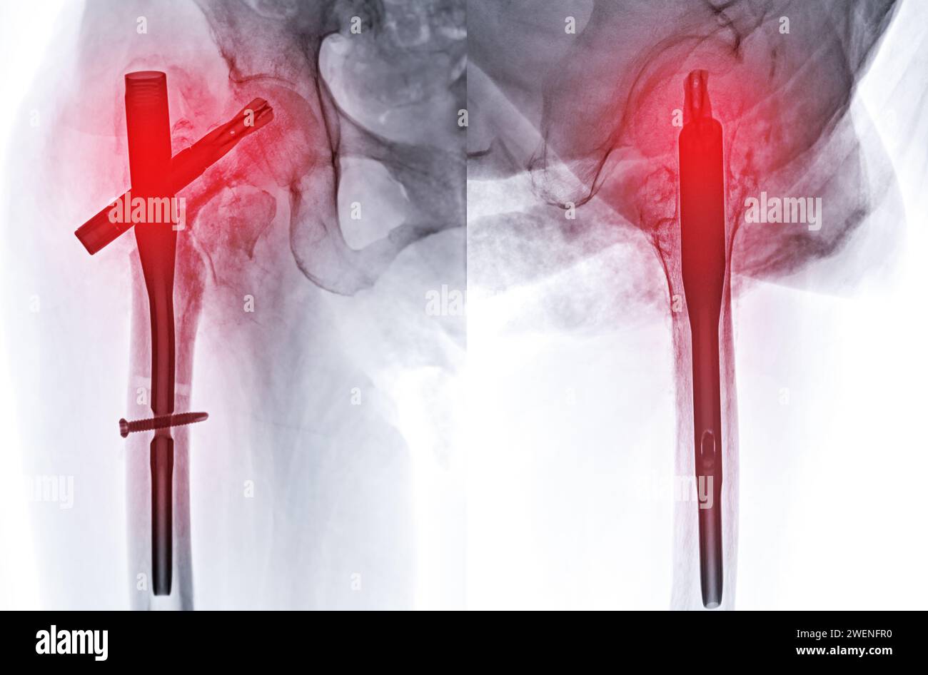 An X-ray reveals both hip joints with hemiarthroplasty, showcasing the ...