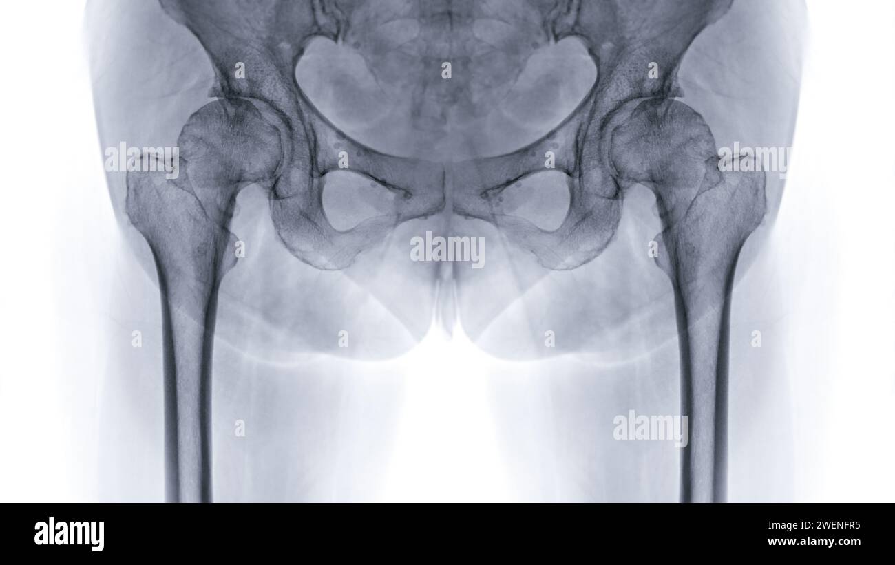 An X-ray reveals both hip joints in normal study Stock Photo - Alamy