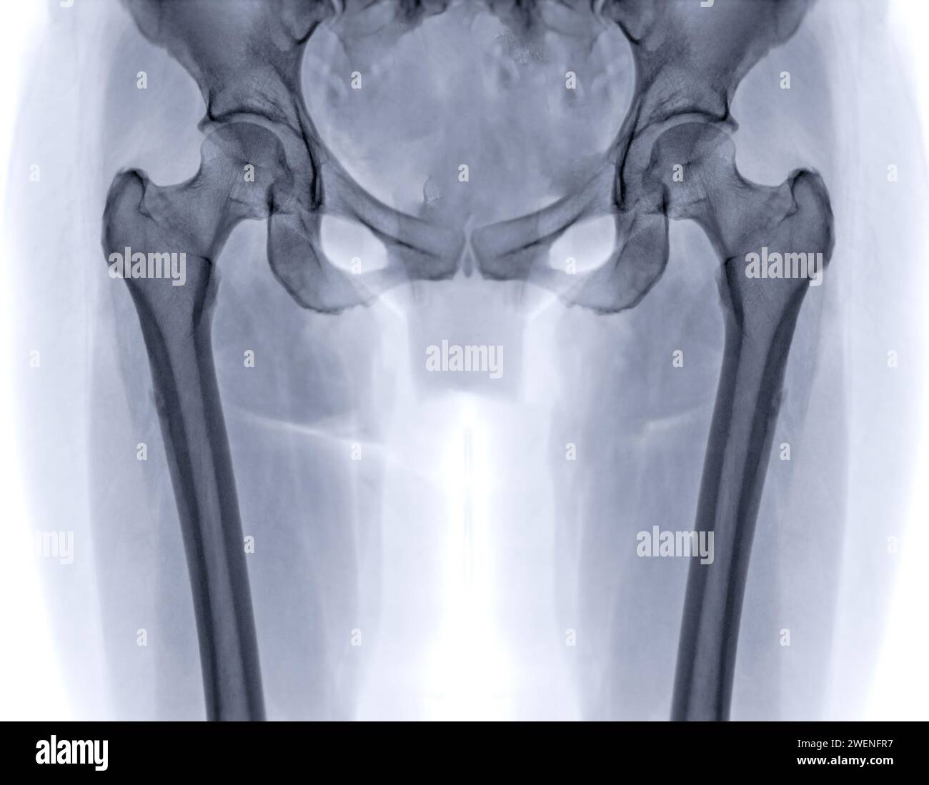 An X-ray reveals both hip joints in normal study Stock Photo - Alamy