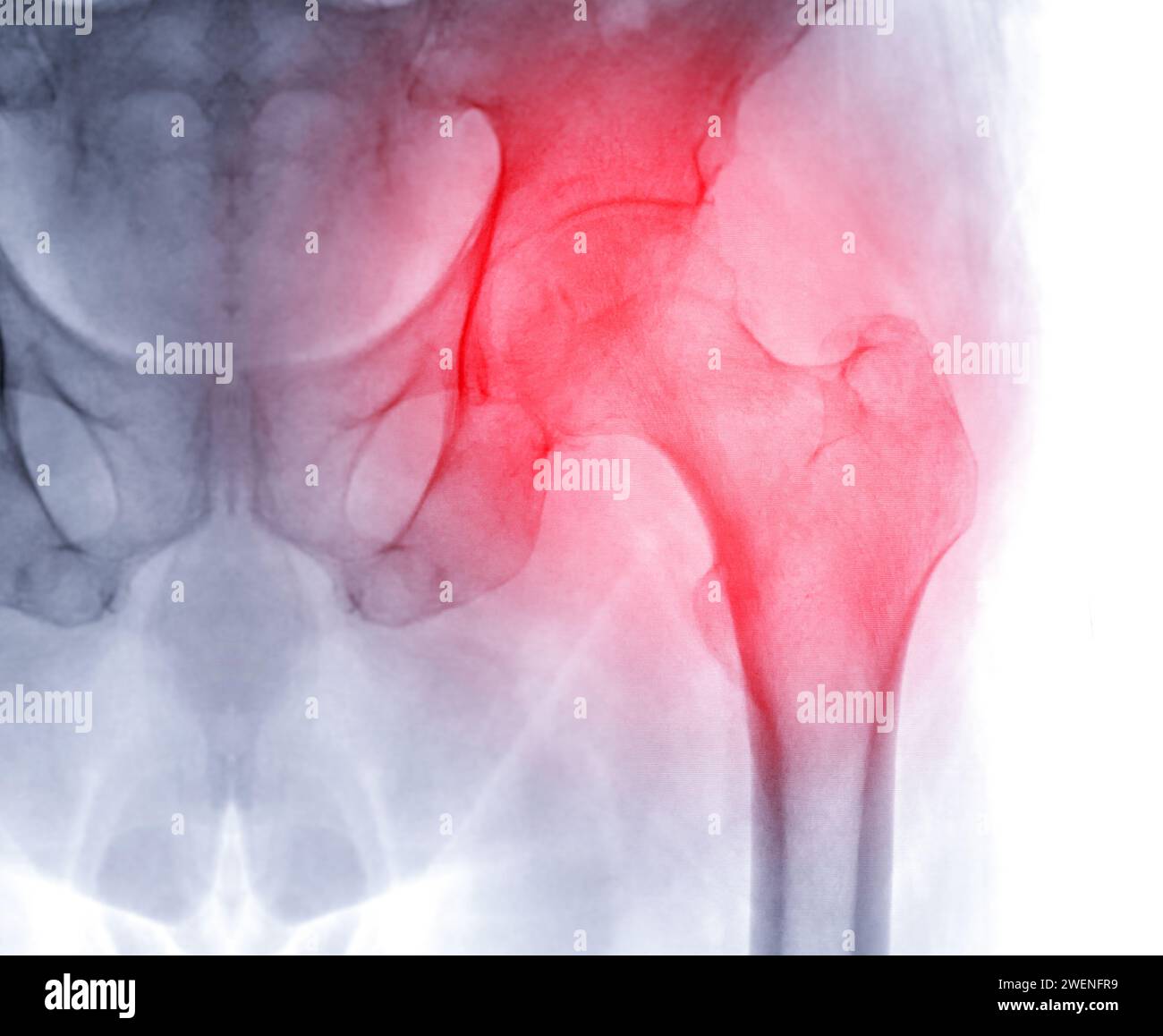 An X-ray reveals both hip joints in normal study Stock Photo - Alamy