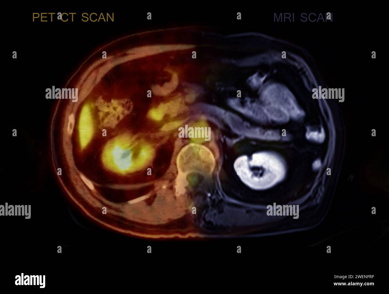 A PET-CT scan image and MRI Abdomen Stock Photo - Alamy