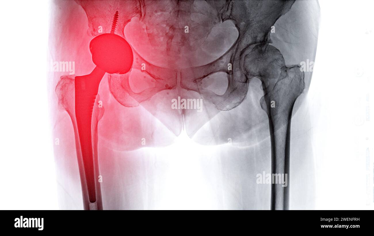 An X-ray reveals both hip joints with TOTAL HIP ARTHROPLASTY ...