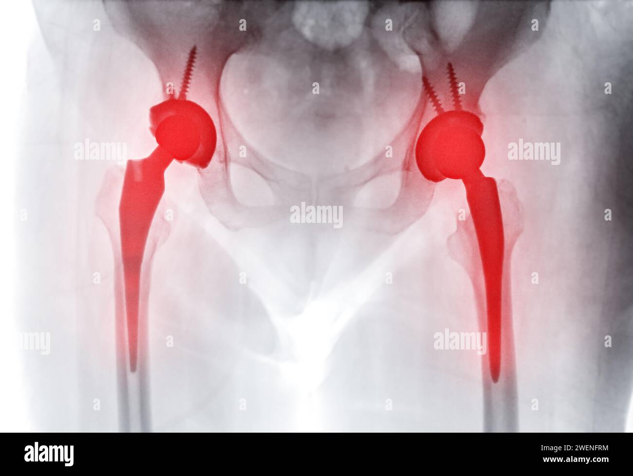 An X-ray reveals both hip joints with TOTAL HIP ARTHROPLASTY ...