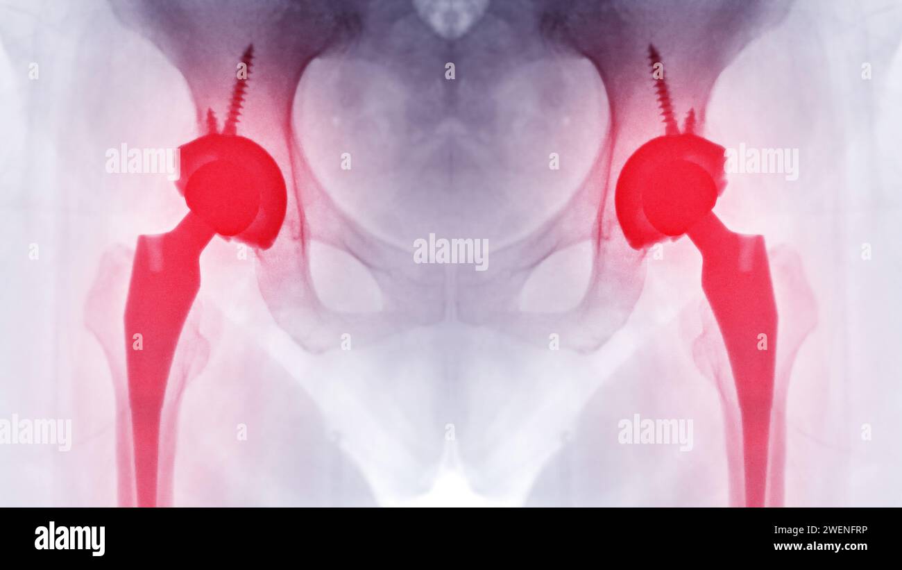 An X-ray reveals both hip joints with TOTAL HIP ARTHROPLASTY ...