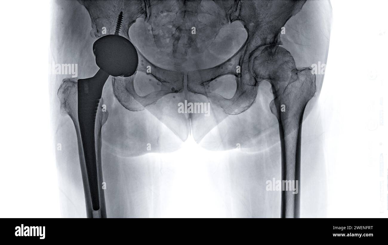 An X-ray reveals both hip joints with TOTAL HIP ARTHROPLASTY ...